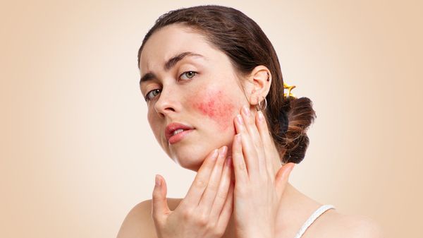 Seborea (seboroická dermatitida): Příčiny, vznik a léčba nemoci